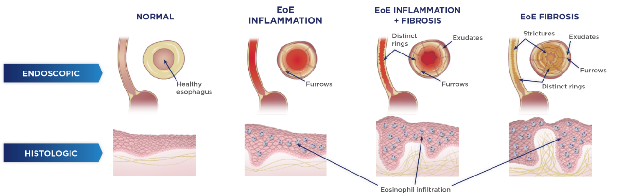 Understanding Eosinophlic Esophagitis (EoE)