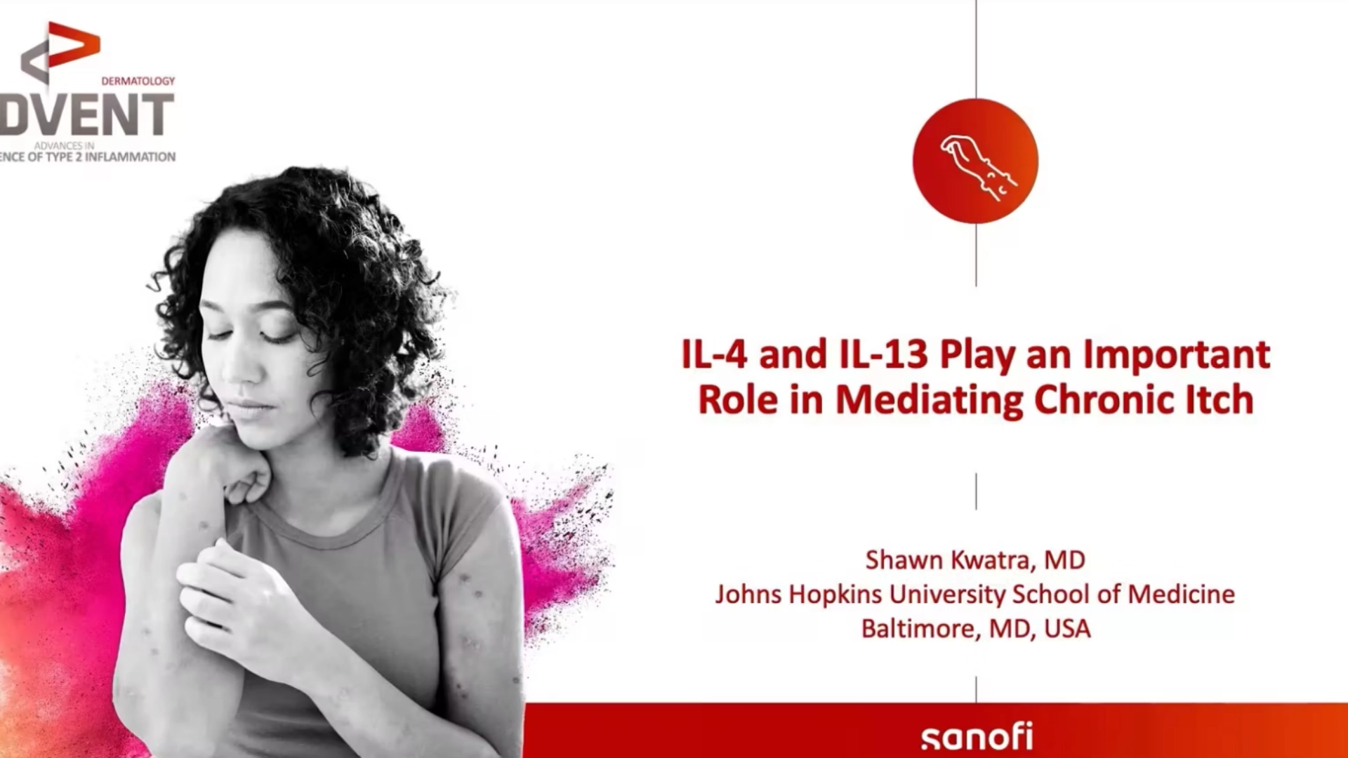 IL4 and IL13 important role in Chronic Itch