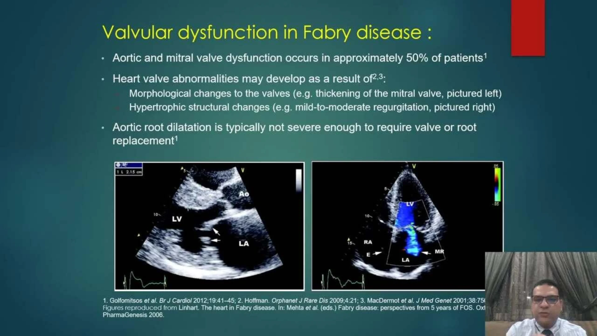 Fabry Disease from Cardiology Perspective