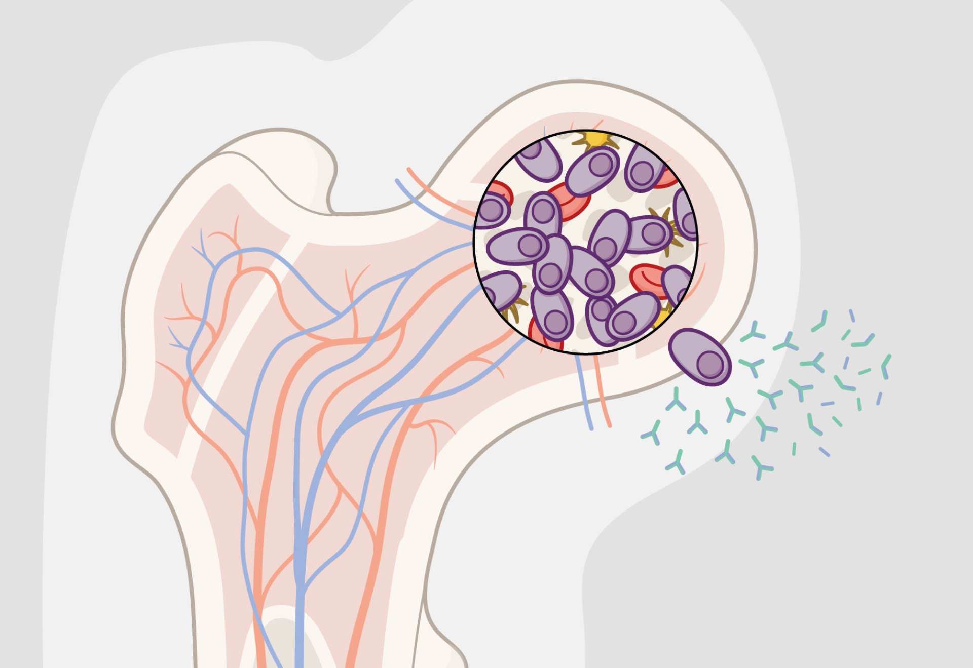 Multiples Myelom