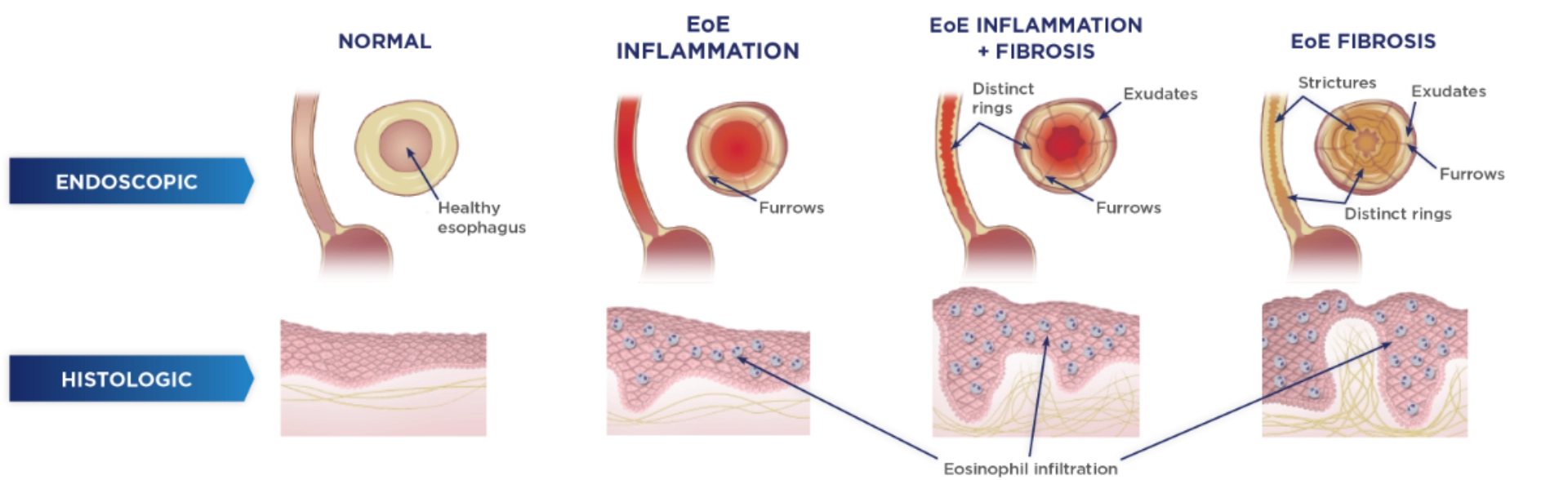 Understanding eosinophilic esophagitis (EoE)