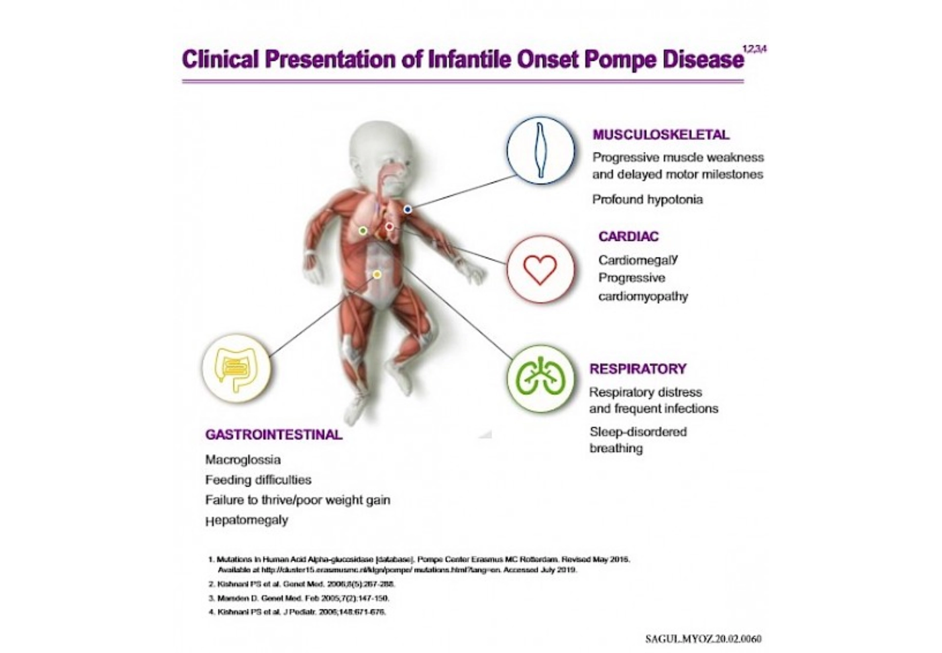 How to diagnose Pompe Disease