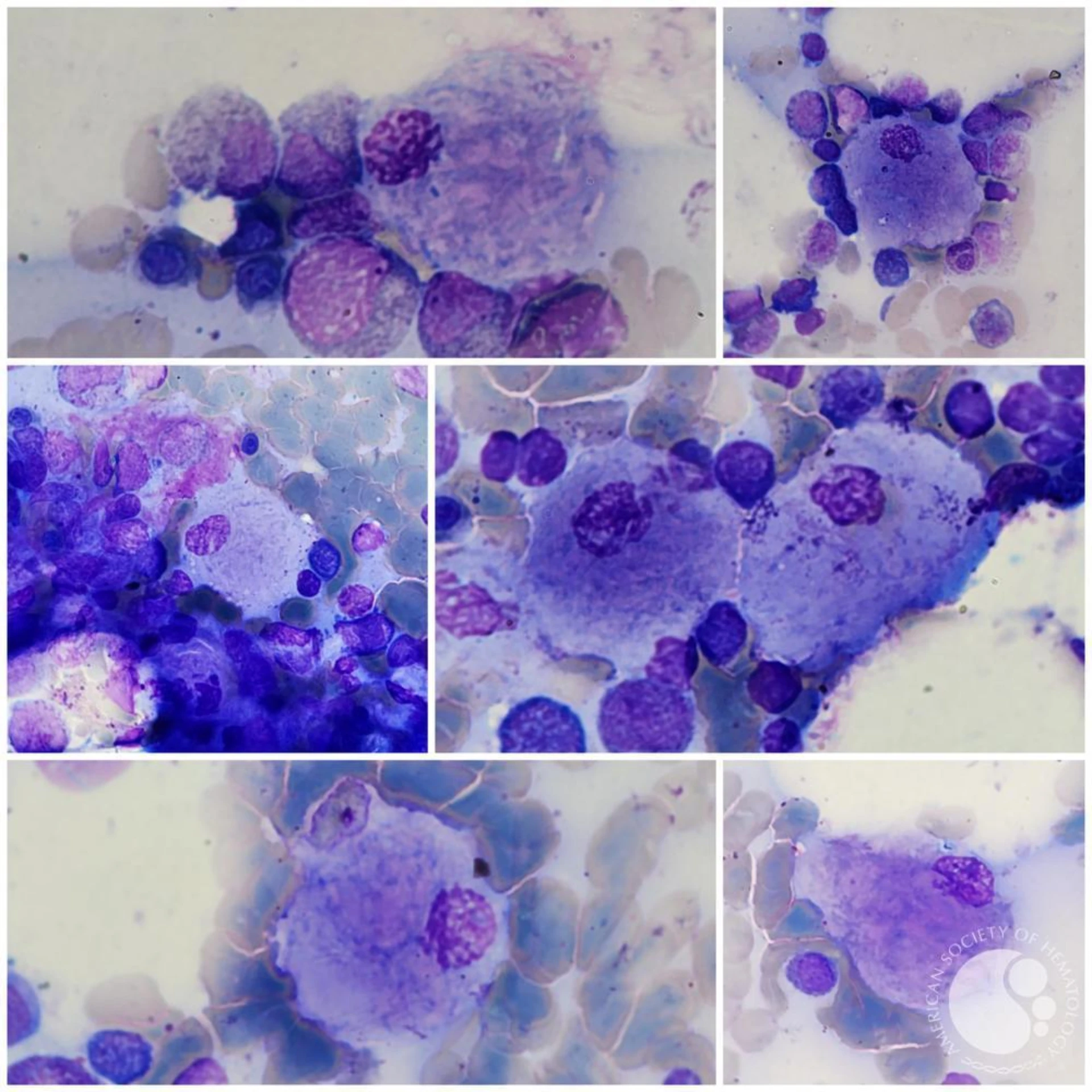 Understanding Gaucher Disease: Symptoms, Classification, and Clinical ...