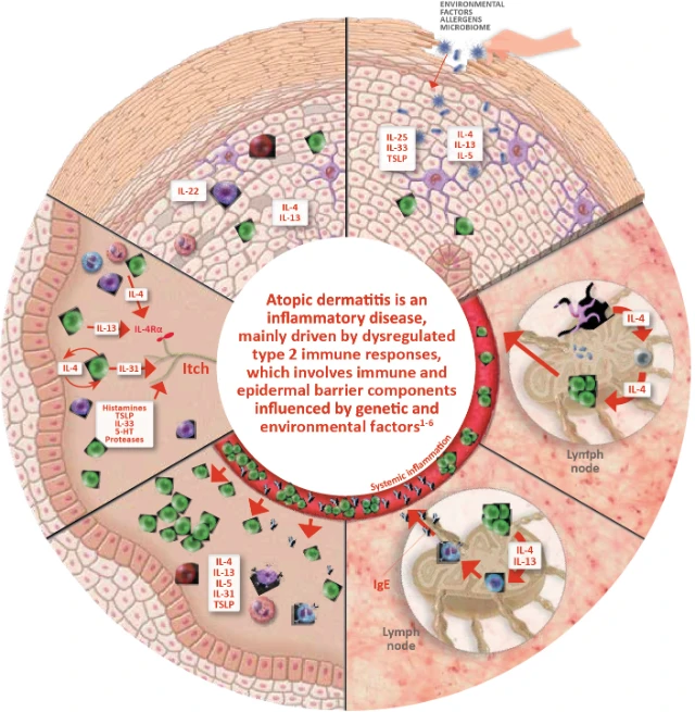 Atopic Dermatitis Pathophysiology: Breaking Down the Barrier