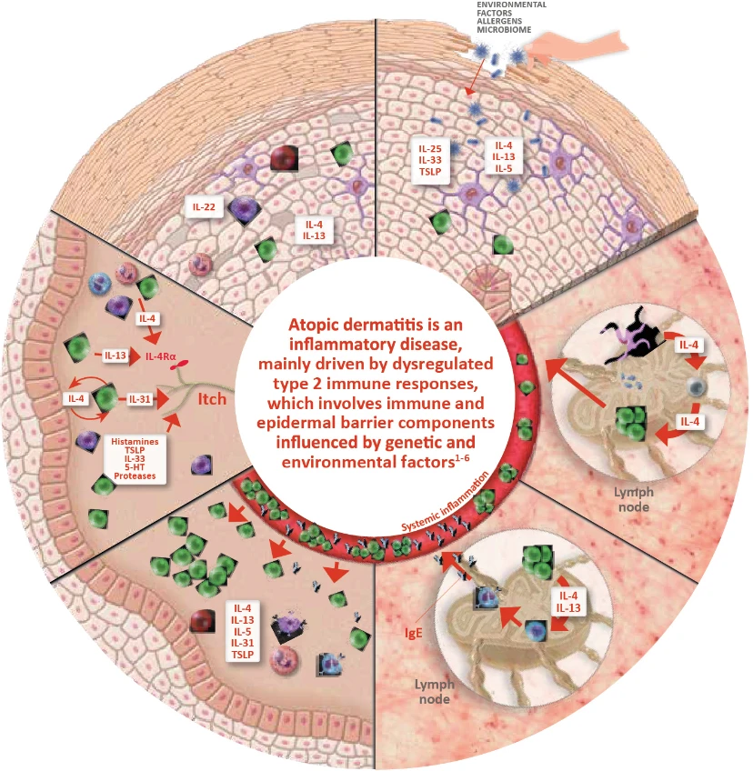 Atopic Dermatitis Pathophysiology: Breaking Down the Barrier